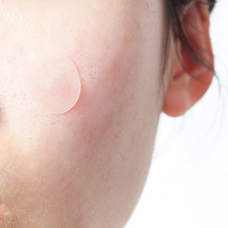 Are microneedle acne patches easy to apply? - Blog